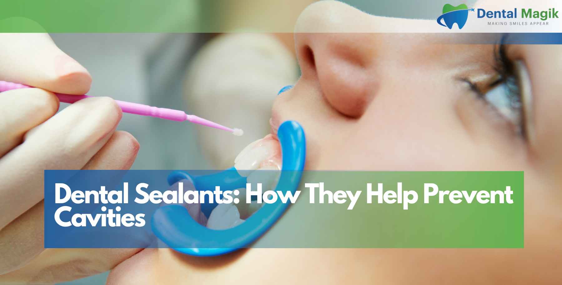 Dental Sealants: How They Help Prevent Cavities | Dental Magik